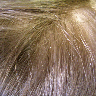 It’s All Lies; It Can’t Be Lice: The Four Steps To Get Rid of Head Lice.